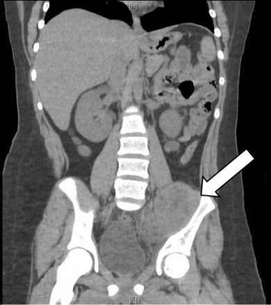 Absceso del psoas - EcuRed