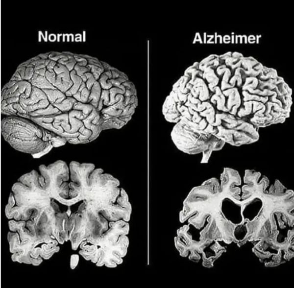 Cerebro - EcuRed
