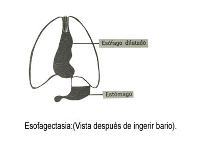 Esofagectasia - EcuRed