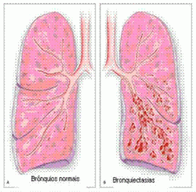 Bronquiectasia - EcuRed