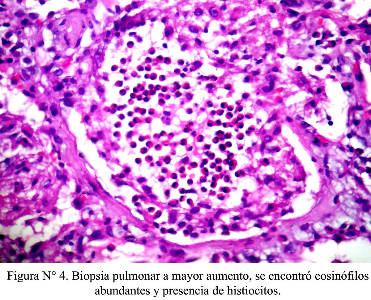 Eosinofilia, Eosinófilos, Tipos, Pulmonar, O Que É Eosinofilia – DFAMZ