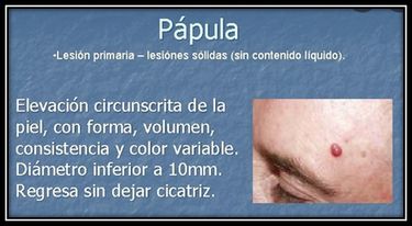 Pápula (lesión o tumor eruptivo de piel) - EcuRed