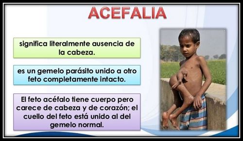 Acefalia - EcuRed